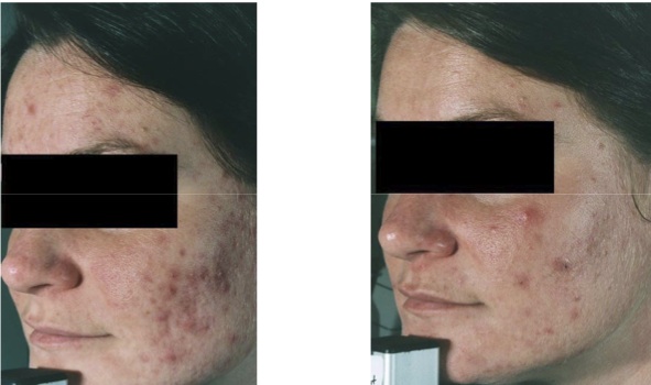 l'I2PL+ Ellipse » Mésothérapie Médecine esthétique 89 - Pour votre ...