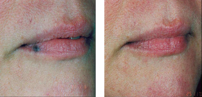 l'I2PL+ Ellipse » Mésothérapie Médecine esthétique 89 - Pour votre ...