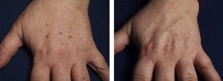 l'I2PL+ Ellipse » Mésothérapie Médecine esthétique 89 - Pour votre ...