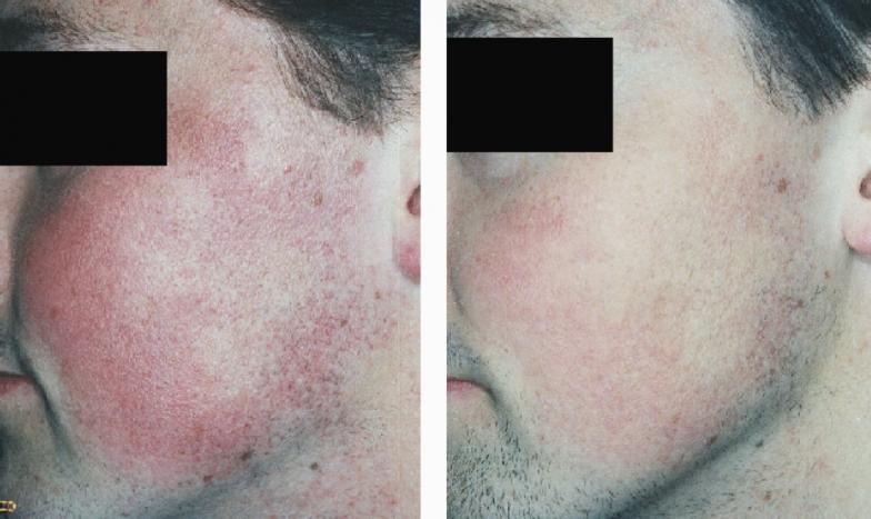 l'I2PL+ Ellipse » Mésothérapie Médecine esthétique 89 - Pour votre ...