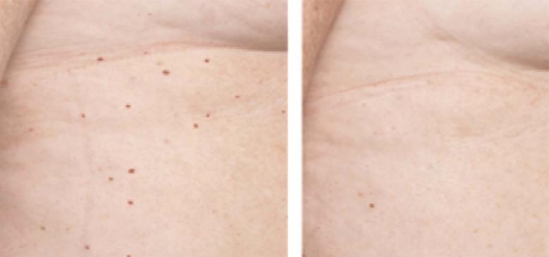 l'I2PL+ Ellipse » Mésothérapie Médecine esthétique 89 - Pour votre ...